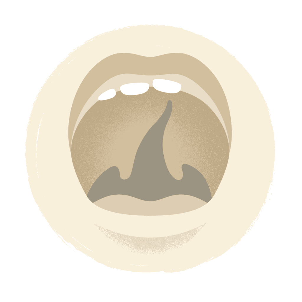 Cleft Palate - Tebow CURE Hospital